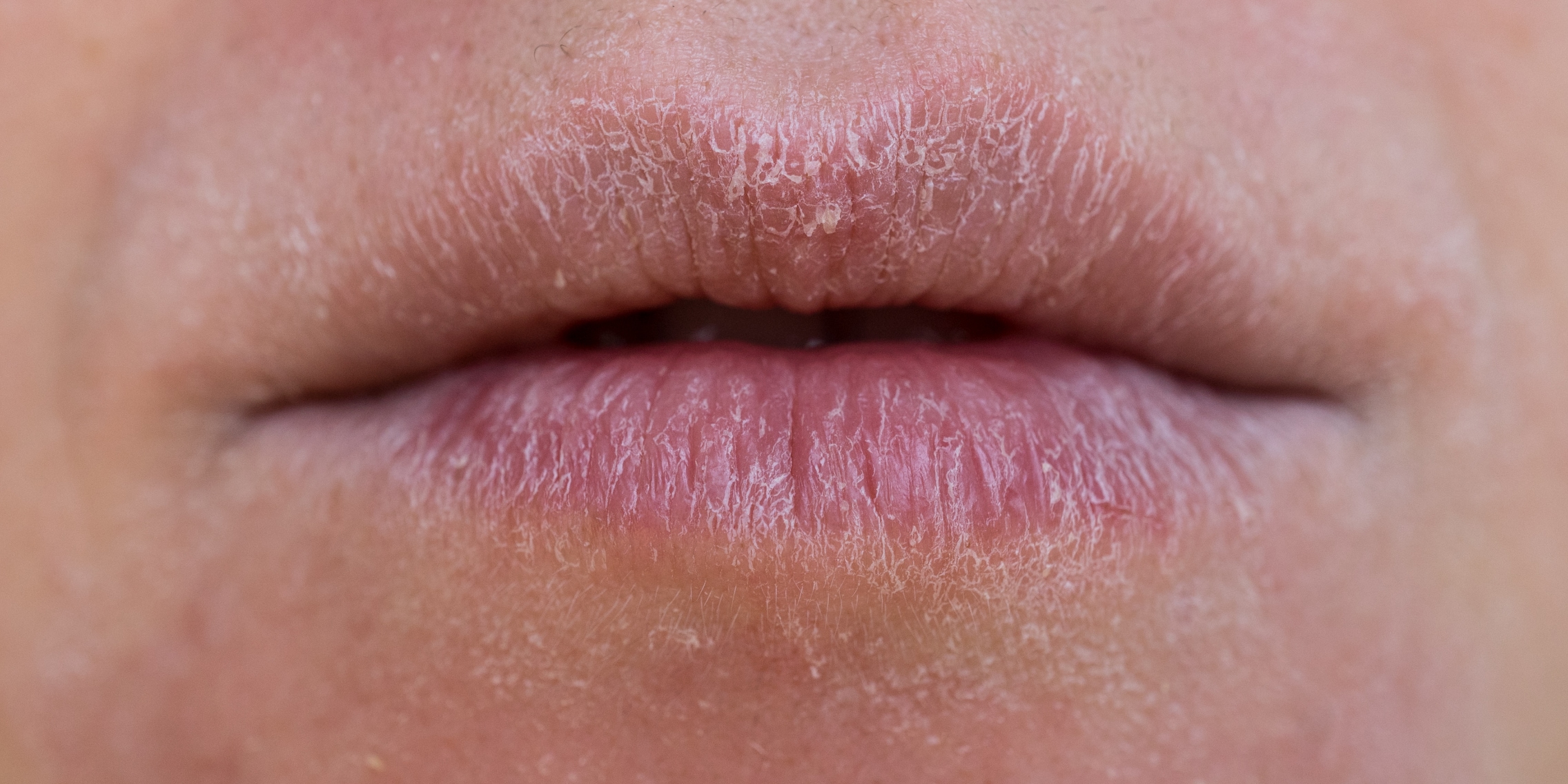 Dry, chapped, sore: when lips hurt - and what can help - Galaxus