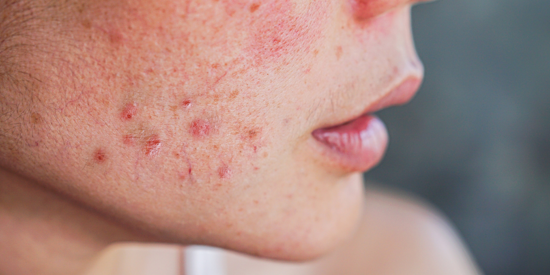 Acne tarda: what helps against adult acne - Galaxus